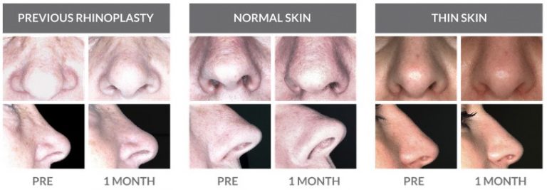 Breathe Well | Latera Nasal Valve Implant - Dr. Jose Barrera, MD