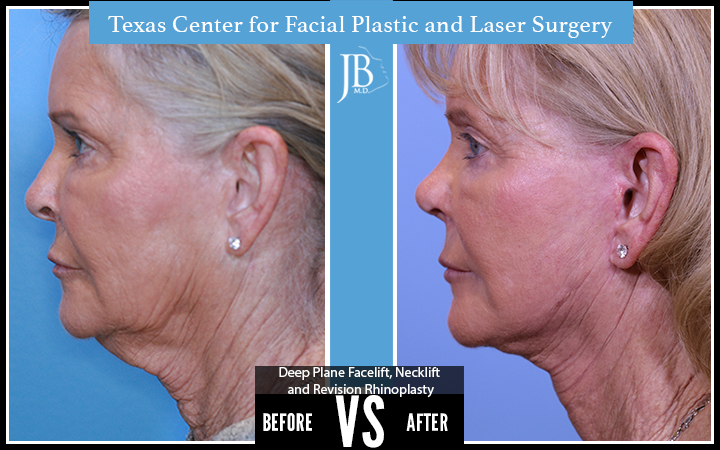 Submentoplasty San Antonio | Neck Band Correction | Neck Lift