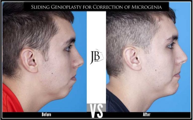 Chin Augmentation for Men | San Antonio | Dr. Jose Barrera