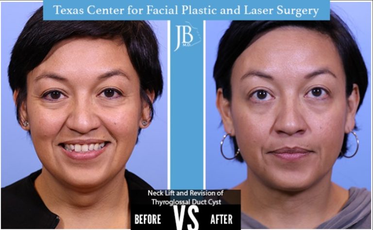 Neck Lift in San Antonio, TX | Lower Rhytidectomy | Dr. Jose Barrera