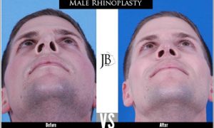 Revision Rhinoplasty San Antonio | Texas Nose Job Repair Dr. Jose Barrera