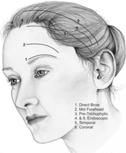 Brow Lift | San Antonio | Dr. Jose Barrera