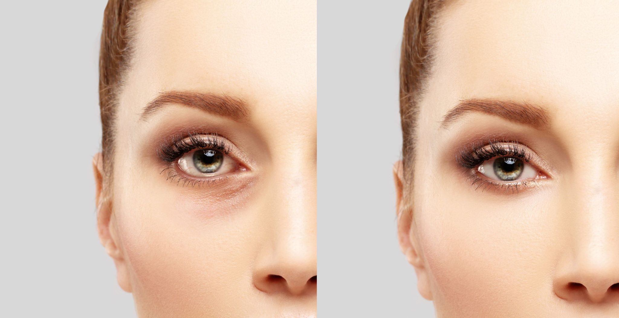 Customized Full Face Fat Grafting San Antonio, TX | Dr. Jose Barrera